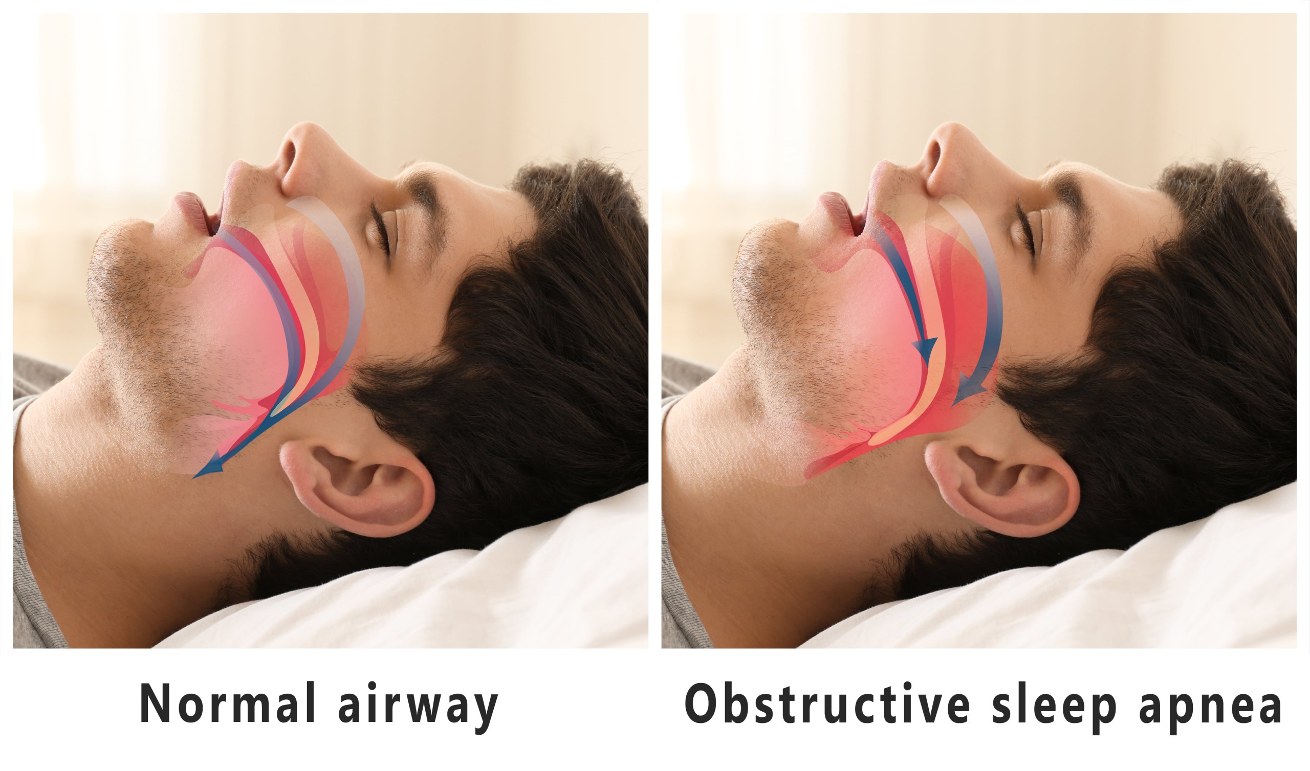 Comprehensive Sleep Apnea Treatment in Kansas City